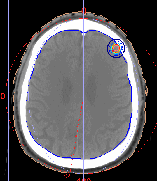 Efficiency & Benefits Of Linac-Based SBRT/SRS Program